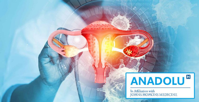 Cancer de l'ovaire : symptômes, causes et traitement au Centre Médical ...