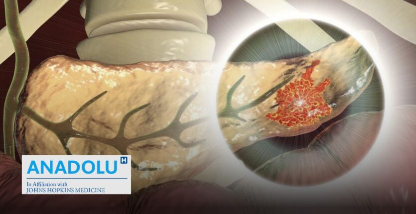 Traitement chirurgical des tumeurs neuroendocrines : techniques, suivi ...